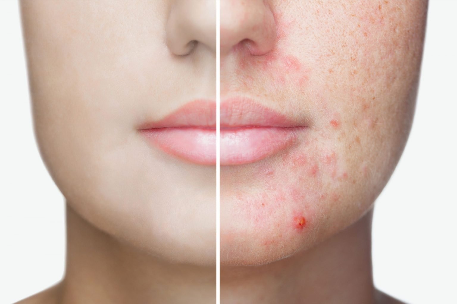 Tri Acne | Divine & Free Spa in St Alberta